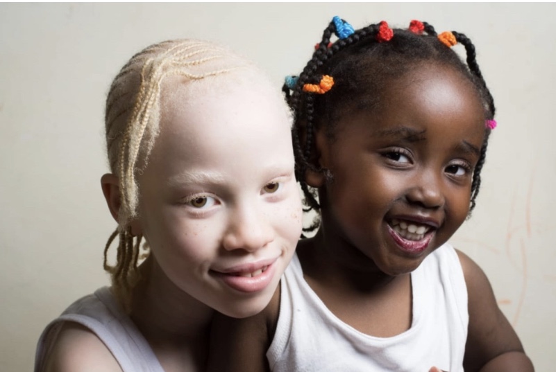 The impact of our albinism awareness program in Kenya – Go Kenya, go ...